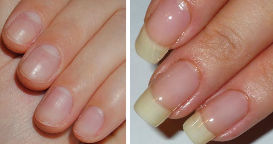 5 Passos para recuperar unhas fracas! Veja como se faz: 5 Passos para recuperar unhas fracas! Veja como se faz: